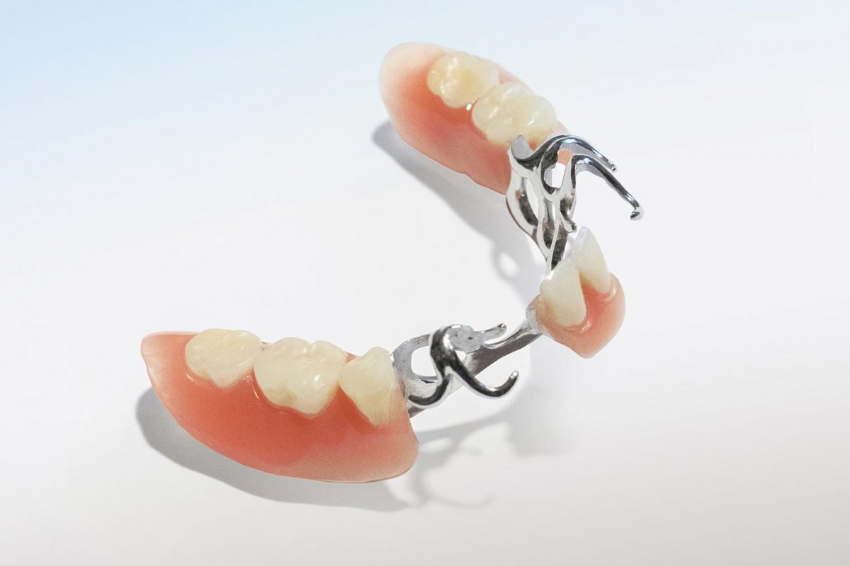 Modellgussprothese mit Metallklammern – Zahn Docs Diez