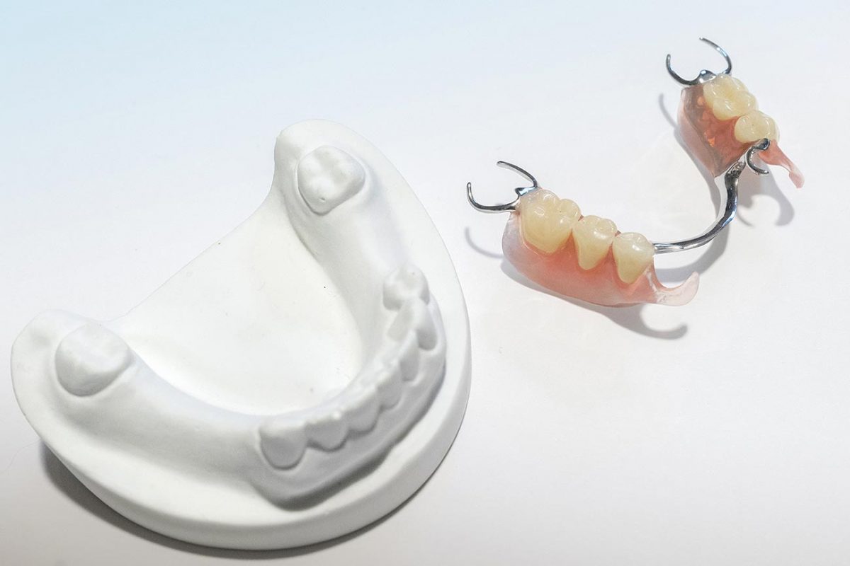 Modellgussprothese mit Metall-Sunflex-Kombination neben Modell – Zahn ...