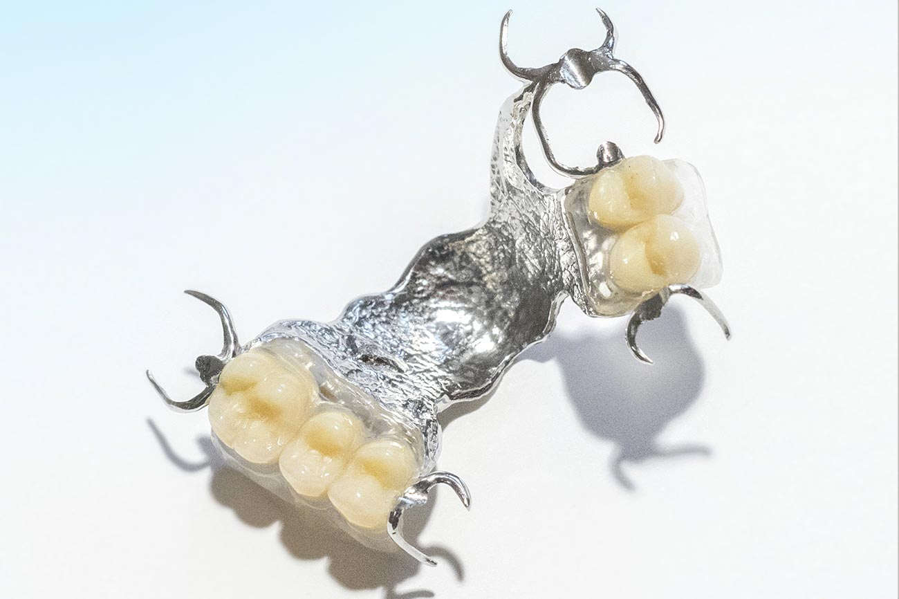 Herausnehmbare Prothese mit Transversalband – Zahn Docs Diez