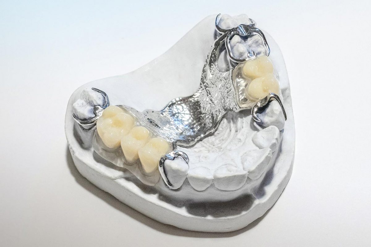 Herausnehmbare Prothese mit Transversalband auf Modell – Zahn Docs Diez