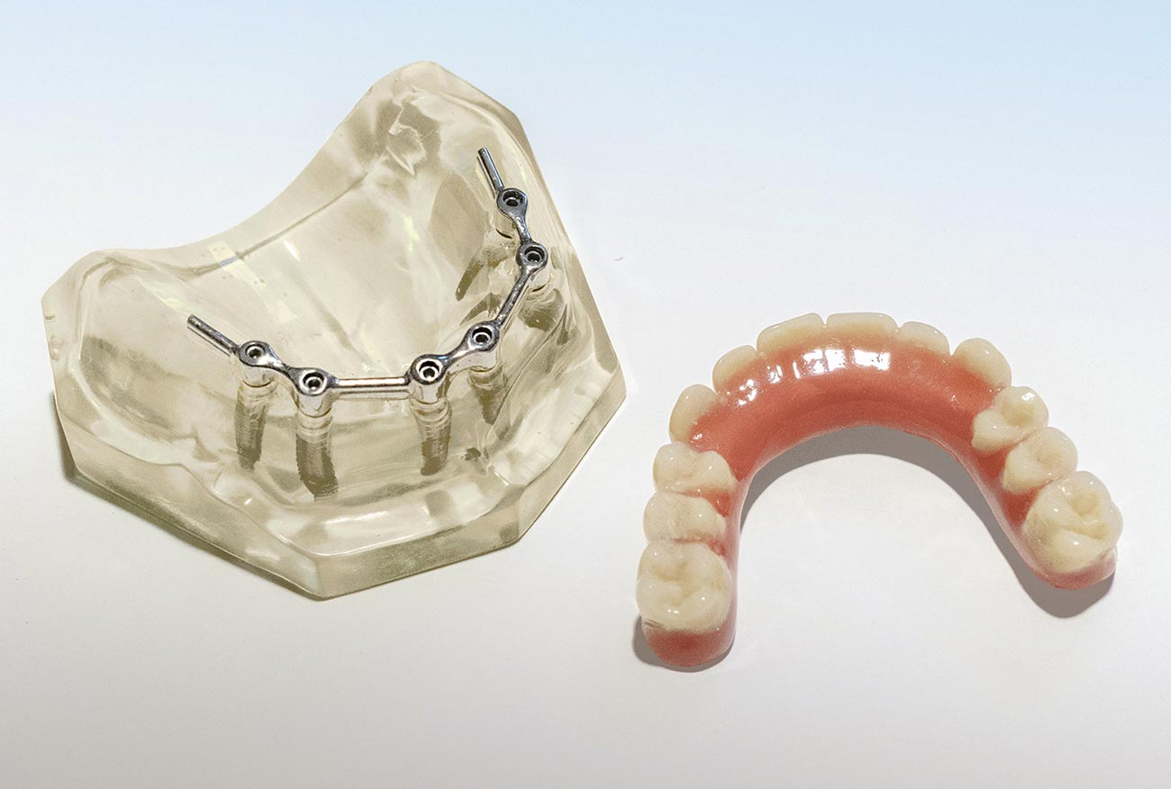 Stegversorgung und implantatgetragene Prothese – Zahn Docs Diez